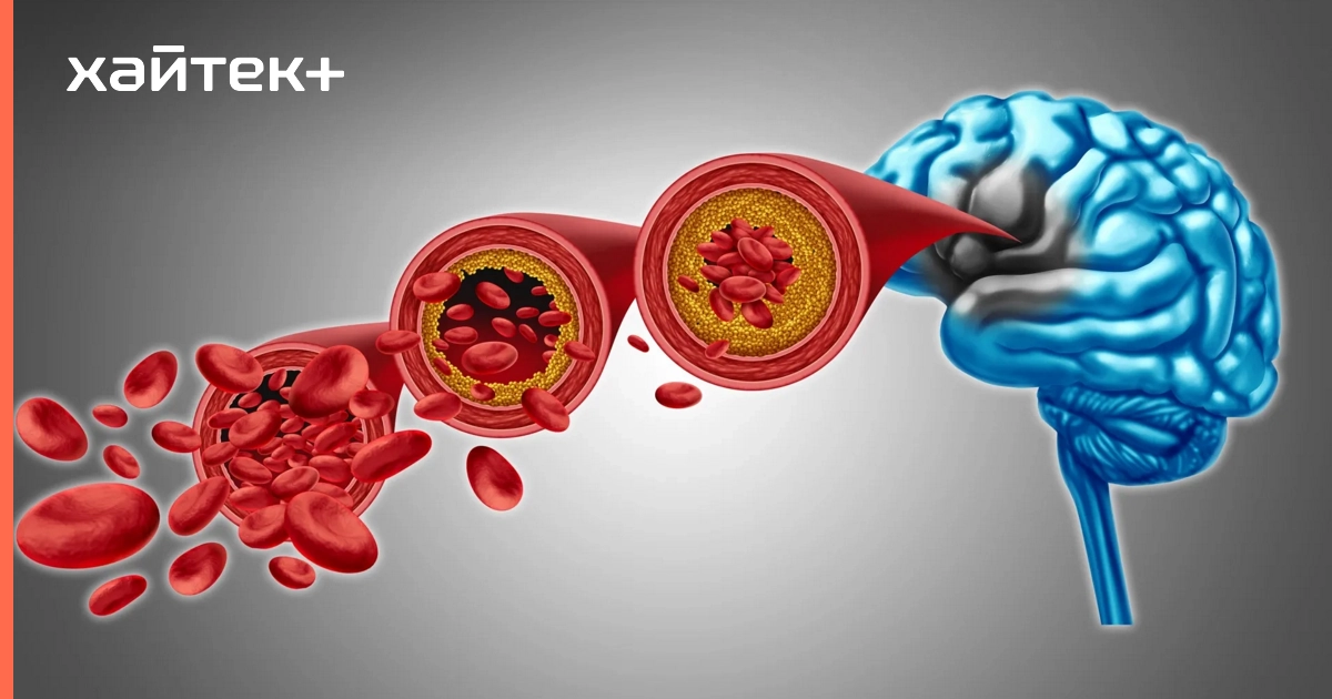Найден способ восстановить кровоток в мозге при деменции